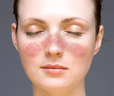 It's Not Lupus!: Lupus Guide for the Perplexed: Malar Rash