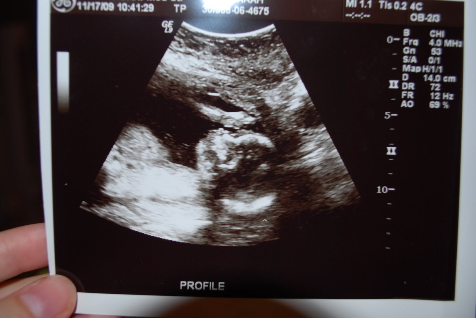 Following The Kies Family: 19 week Ultrasound...........