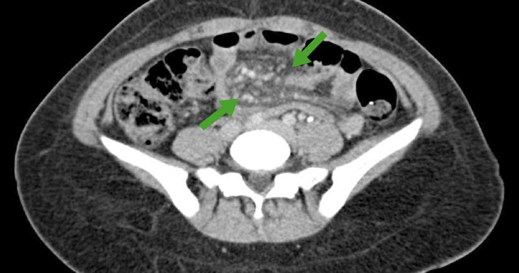 BLOG SCAN - RA Radiologistas Associados: HERNIA INTERNA