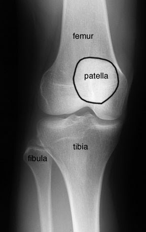 fisioterapia: • FRATURAS DA PATELA