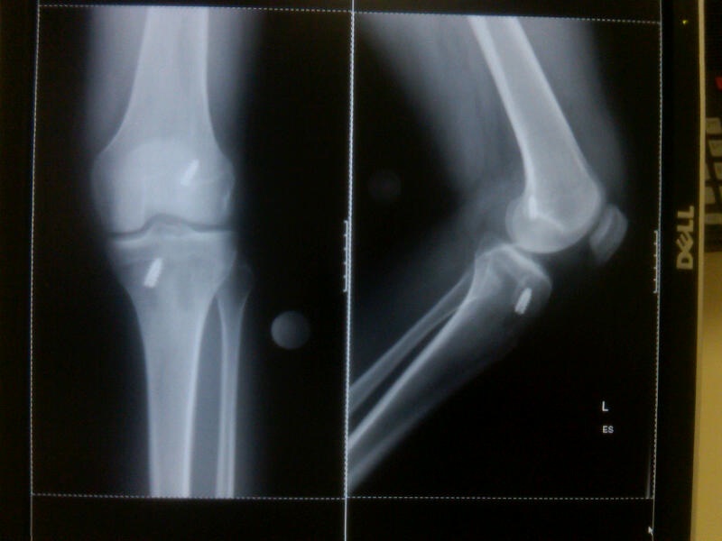 Nick's New Knee: My Patellar Autograft ACL Reconstruction: 2 Week Post ...