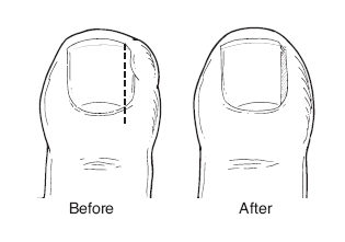 Ingrown Toenail Diagram ~ Ingrown Toenail
