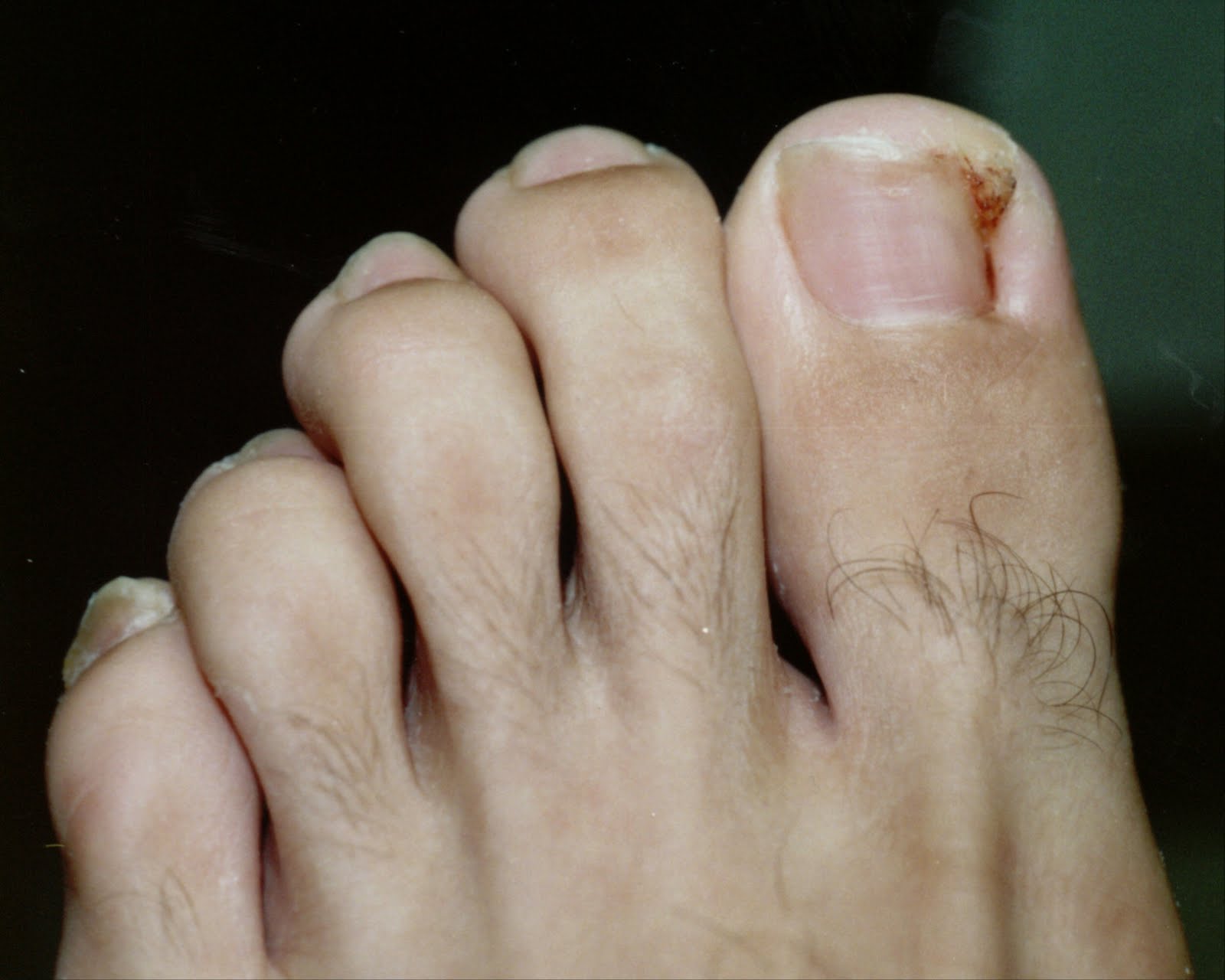 Pictures Of Ingrown Toenails ~ Ingrown Toenail