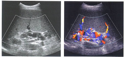 Portal Hypertension USG