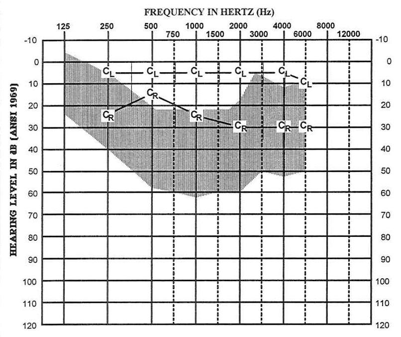 The ASL-Cochlear Implant Community: Audiogram