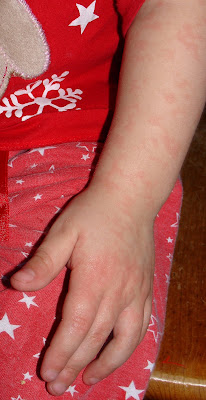 The Good Life: Fifth Disease (Slapped Cheek Syndrome)