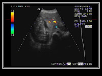 MEDIC Vietnamese Ultrasound Diagnosis: HEPATIC ECTOPIC PREGNANCY, PHAN ...