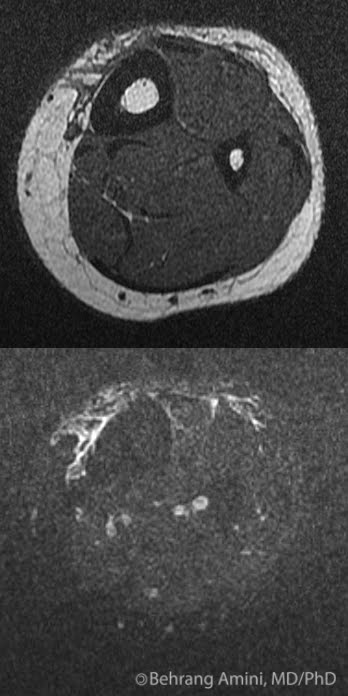 Roentgen Ray Reader: Shin Splints vs Stress Fracture on MRI