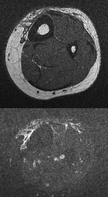 Roentgen Ray Reader: Shin Splints vs Stress Fracture on MRI
