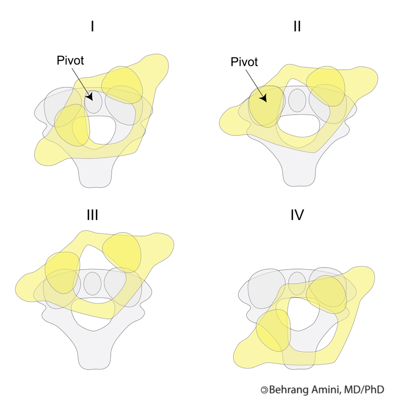Roentgen Ray Reader: Atlantoaxial Rotatory Subluxation