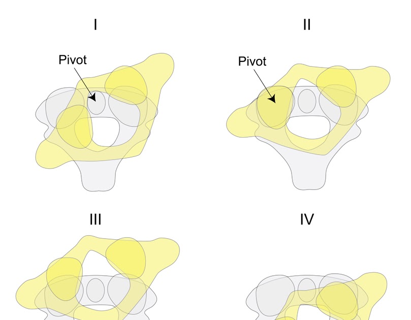 Roentgen Ray Reader: Atlantoaxial Rotatory Subluxation