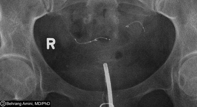 Roentgen Ray Reader: Radiographic, Sonographic, and MRI Appearance of ...