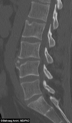 Roentgen Ray Reader: Limbus Vertebrae
