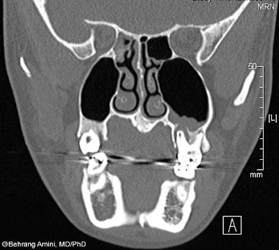 Roentgen Ray Reader: Periapical Cyst