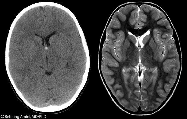 Roentgen Ray Reader Colloid Cyst