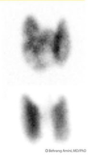 Roentgen Ray Reader: Toxic Multinodular Goiter vs Graves Disease