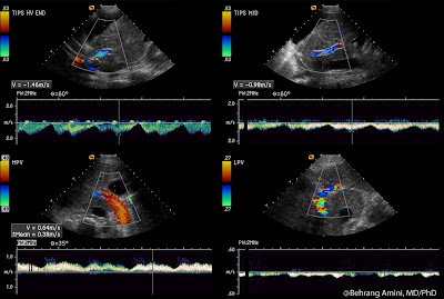 Roentgen Ray Reader: Transjugular Intrahepatic Portosystemic Shunt ...