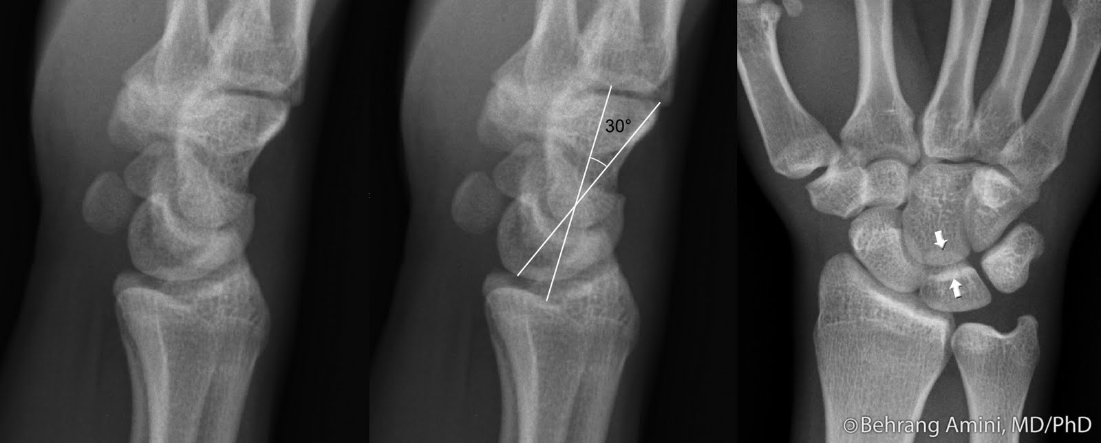 Roentgen Ray Reader: Dorsal Intercalated Segmental Instability (DISI)