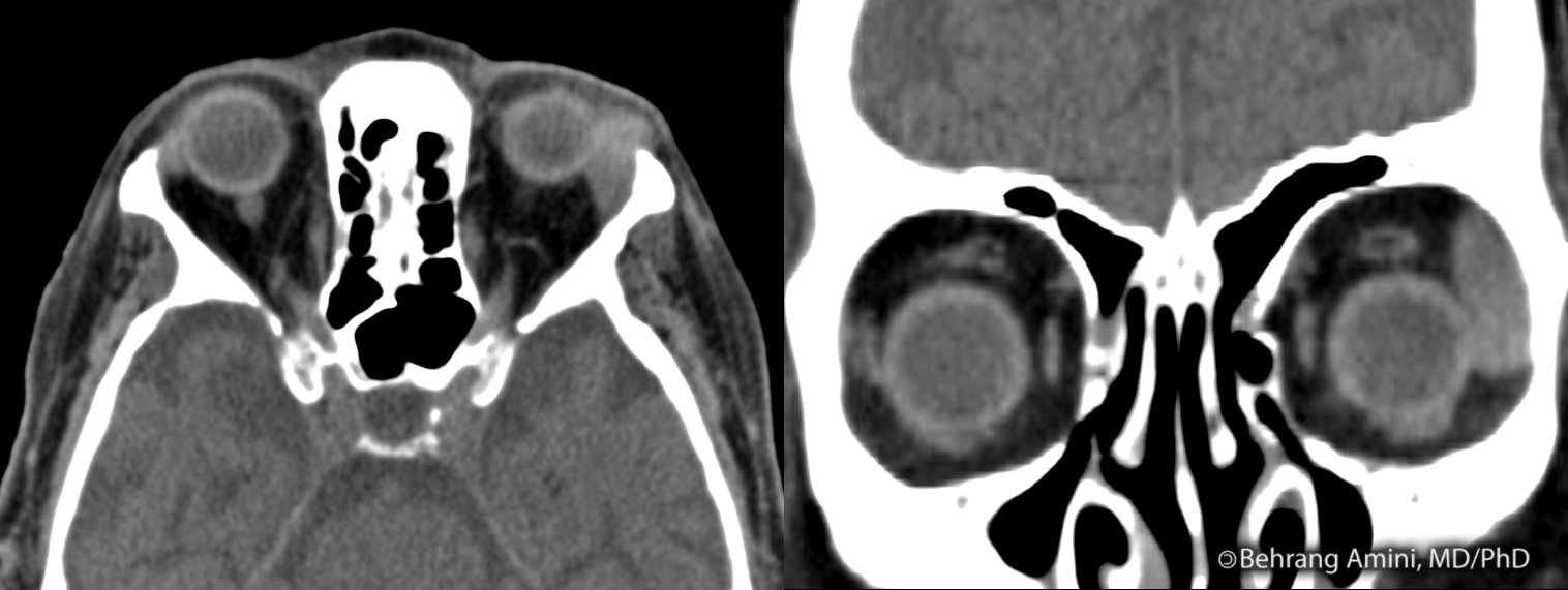Roentgen Ray Reader: Extraconal Lesions