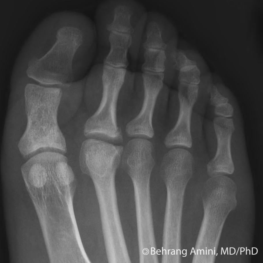 Roentgen Ray Reader: Freiberg Infraction