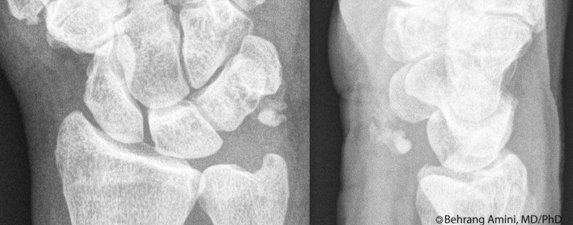 Roentgen Ray Reader: Flexor Carpi Ulnaris Calcium Hydroxyapatite Deposition