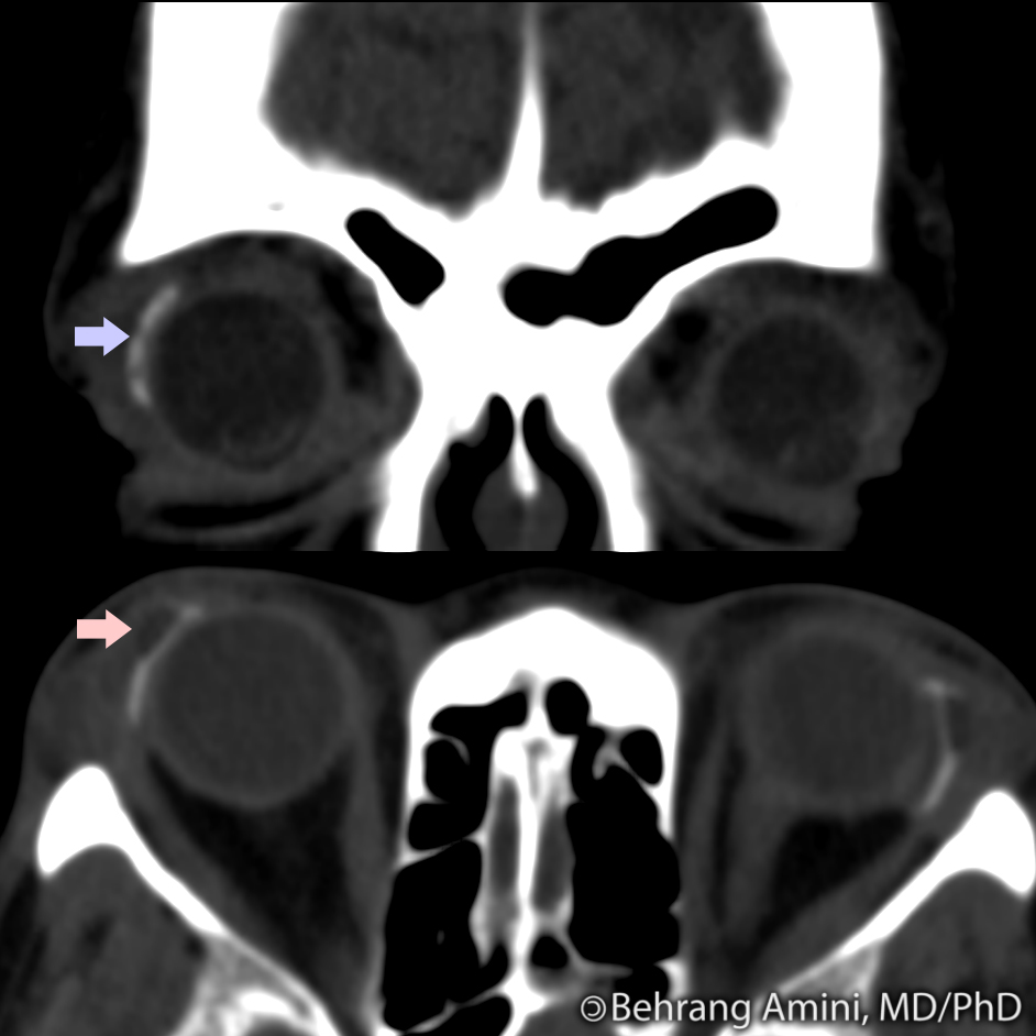 Roentgen Ray Reader: Glaucoma Drainage Implants on CT