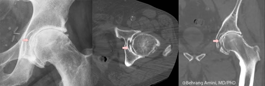 Roentgen Ray Reader: Central Acetabular Osteophytes