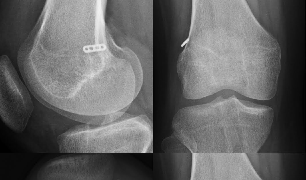 Roentgen Ray Reader: Endobutton
