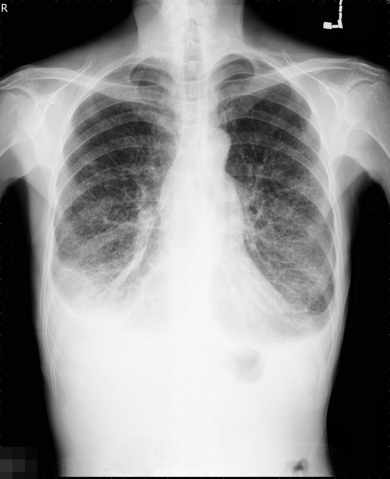 CXR 胸部x光判讀 lymphangioleiomyomatosis (LAM)