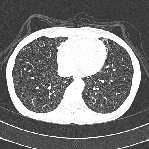 CXR 胸部x光判讀 lymphangioleiomyomatosis (LAM)