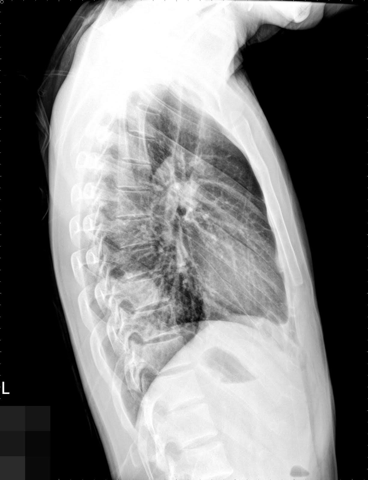 CXR 胸部x光判讀 lung abscess