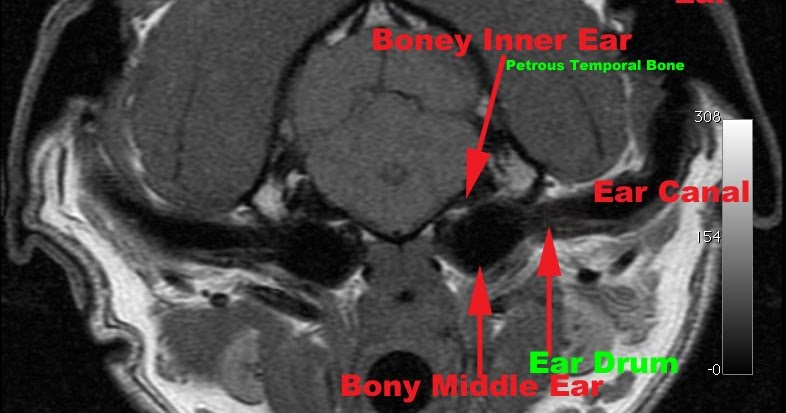 MRI+AXIAL+Showing+ear+canal.0001.jpg