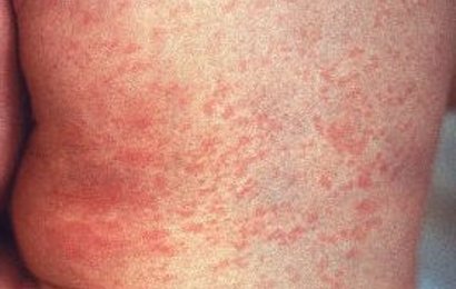 Djimodji Health, Education And Sciences: Campak Jerman (Rubella)