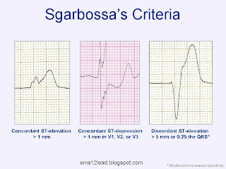 Sgarbossa's Criteria – New Graphic | EMS 12 Lead