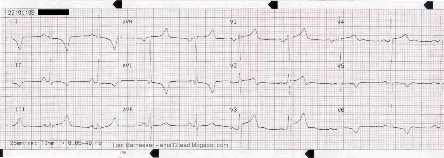 Internship.preparation: LVH/ repolarization defects vs STEMI