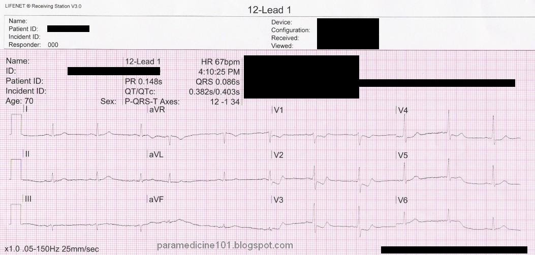 Anterior ischemia or posterior STEMI? | Paramedicine 101