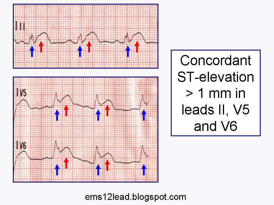 Concordant ST-elevation | EMS 12 Lead