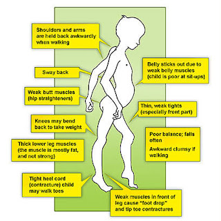 MOZAC BIOLOGY DEPARTMENT: MUSCULAR DYSTROPHY
