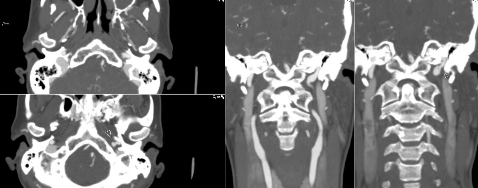 Carotis Dissection Healing