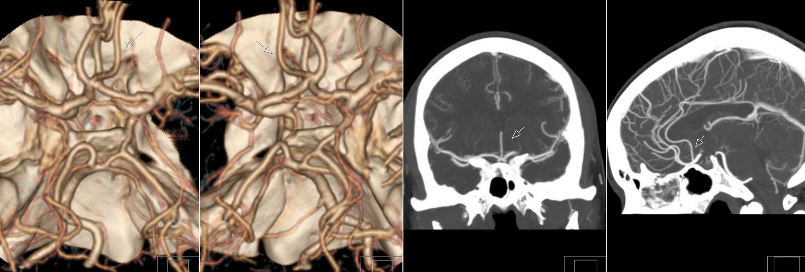 Anterior Cerebral Artery Trifurcation