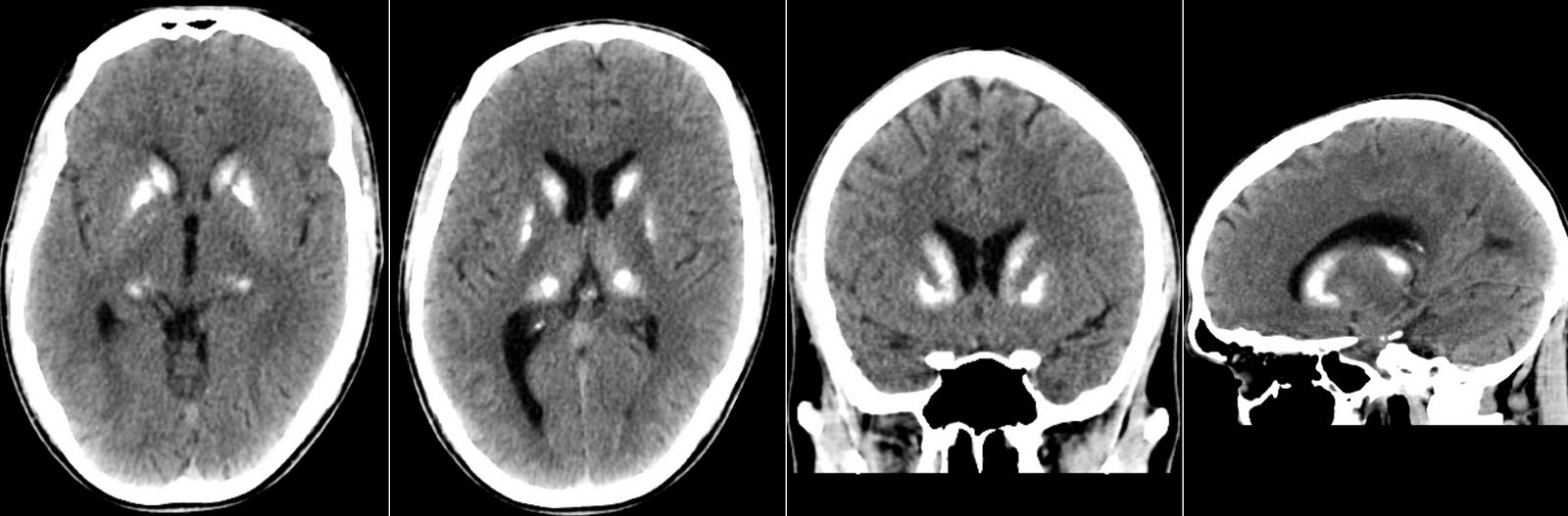 Radiology MRI: Fahr Disease