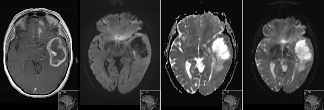 Diffusion Weighted Imaging - MRI