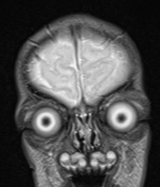 Radiology MRI: Neonatal MRI Faces