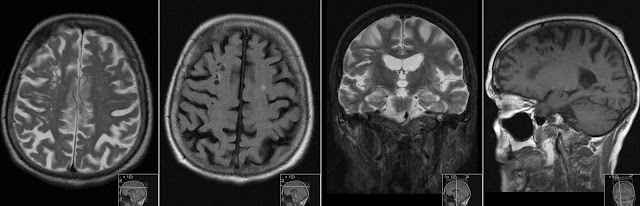 Dilated Perivascular Spaces in the Brain