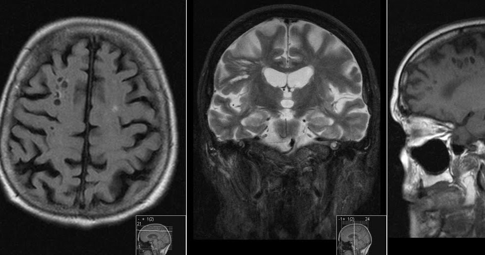 Radiology MRI: Dilated Perivascular Spaces in the Brain