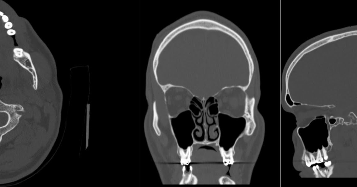 Radiology MRI: Dental Caries on CT