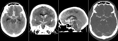 Anterior Communicating Artery Aneurysm Rupture