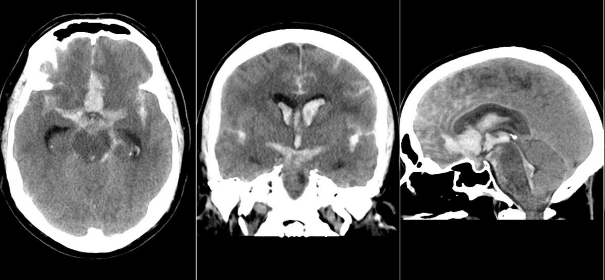 Radiology MRI: Anterior Communicating Artery Aneurysm Rupture