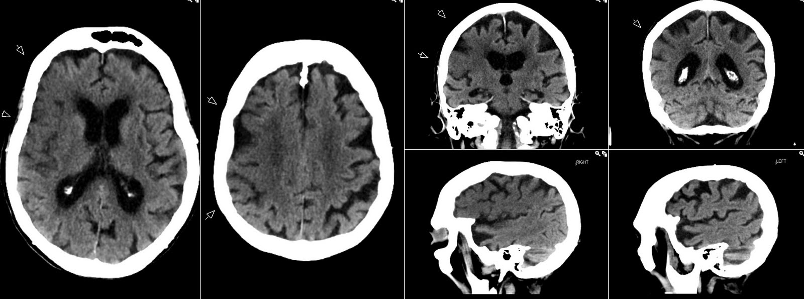 Age Of Infarct Mri Radiology at Stefanie Norton blog