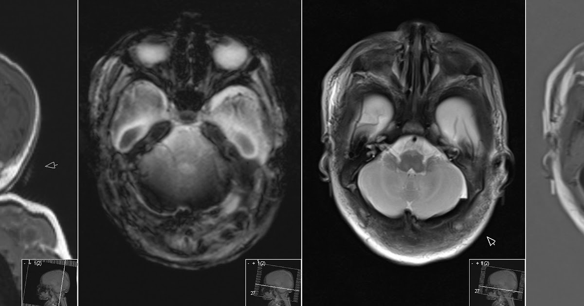 Intracranial Hemorrhage on MRI